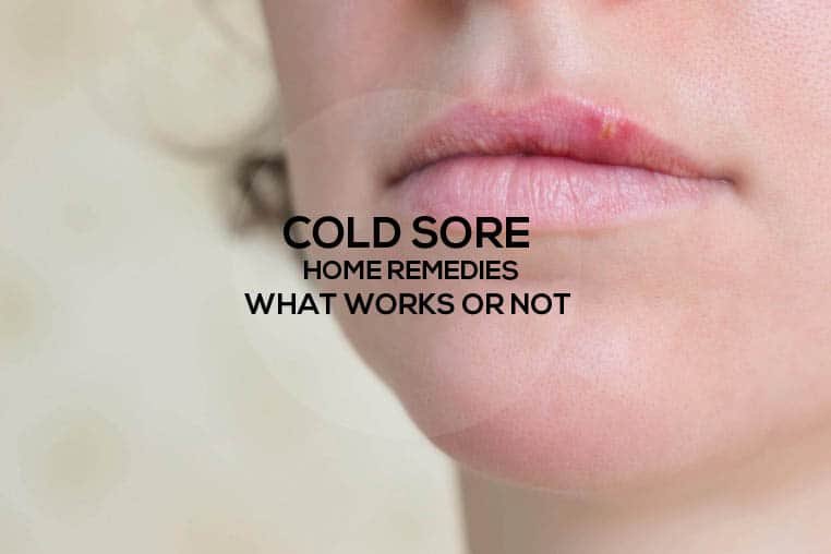 Cold Sore Home Remedies - My Experience with What Works or Not - wikiJunkie